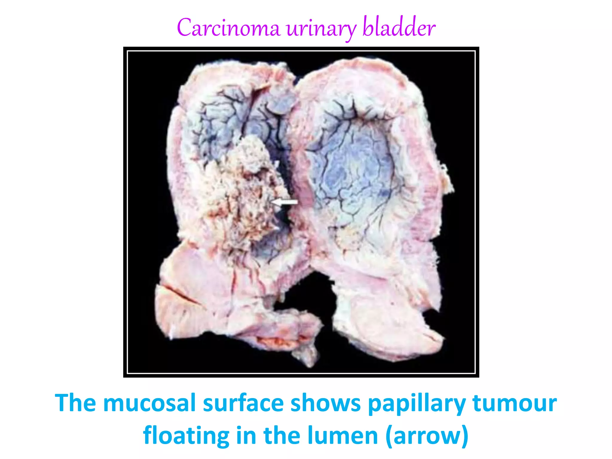 RENAL CELL CARCINOMA, Urothelial (Transitional Cell) Bladder Tumours | PPTX
