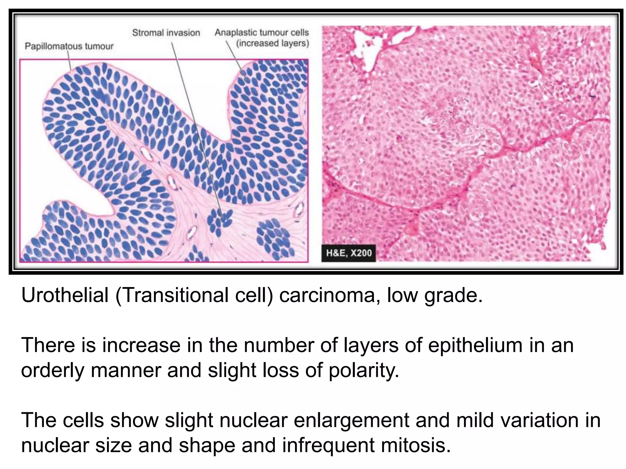 RENAL CELL CARCINOMA, Urothelial (Transitional Cell) Bladder Tumours | PPTX