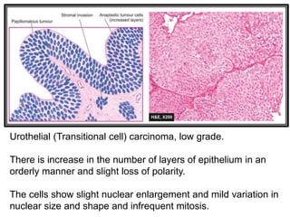Transitional Cell Carcinoma
