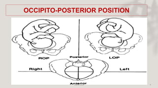 2 malpresentations. (2)- OP | PDF | Pregnancy | Reproductive Health
