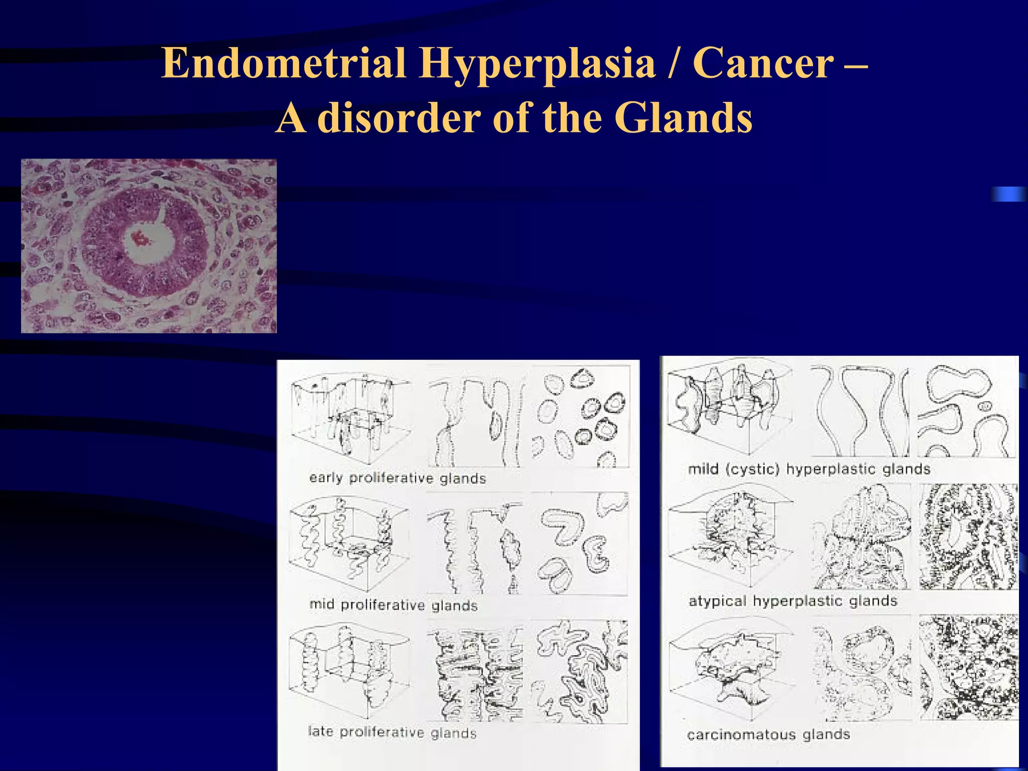 2-medical treatment of endometrial hyperplasia and endometrial cancer | PDF