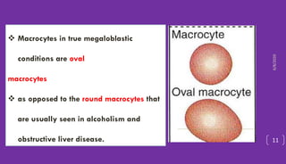 Megaloblastic anemia | PDF