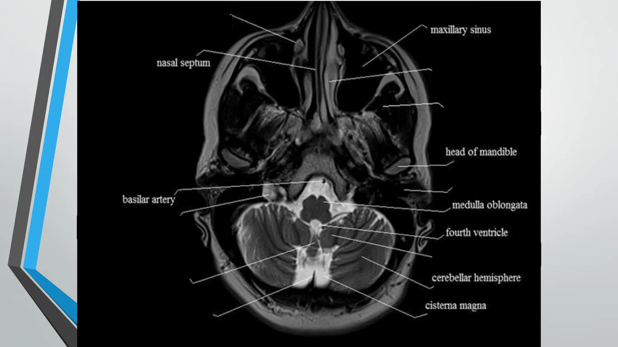 2- MRI Anatomy RMI 317 Brain Anatomy - Part 1 .pdf