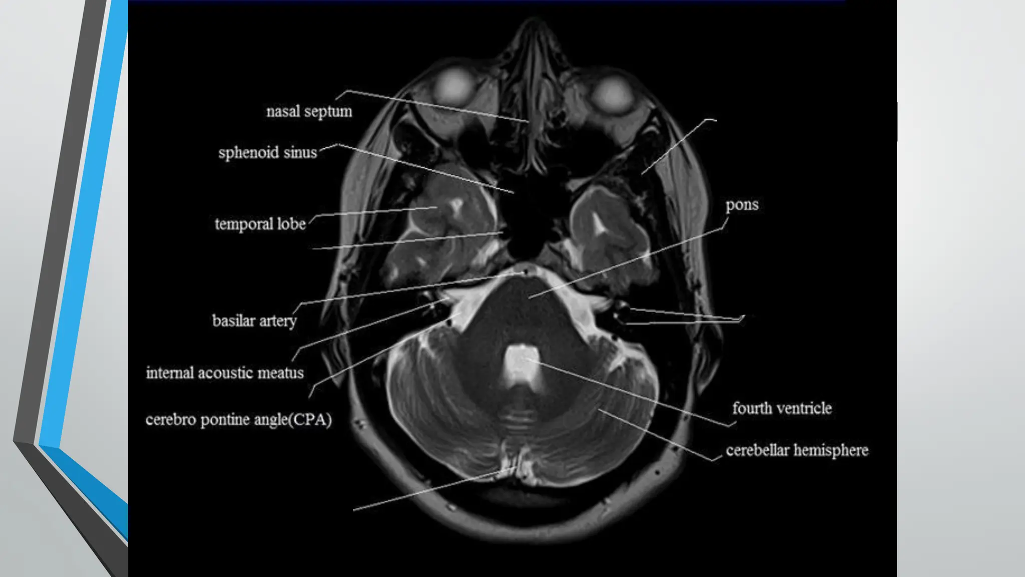 2- MRI Anatomy RMI 317 Brain Anatomy - Part 1 .pdf