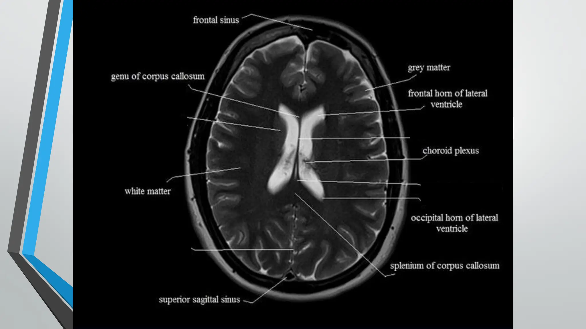 2- MRI Anatomy RMI 317 Brain Anatomy - Part 1 .pdf