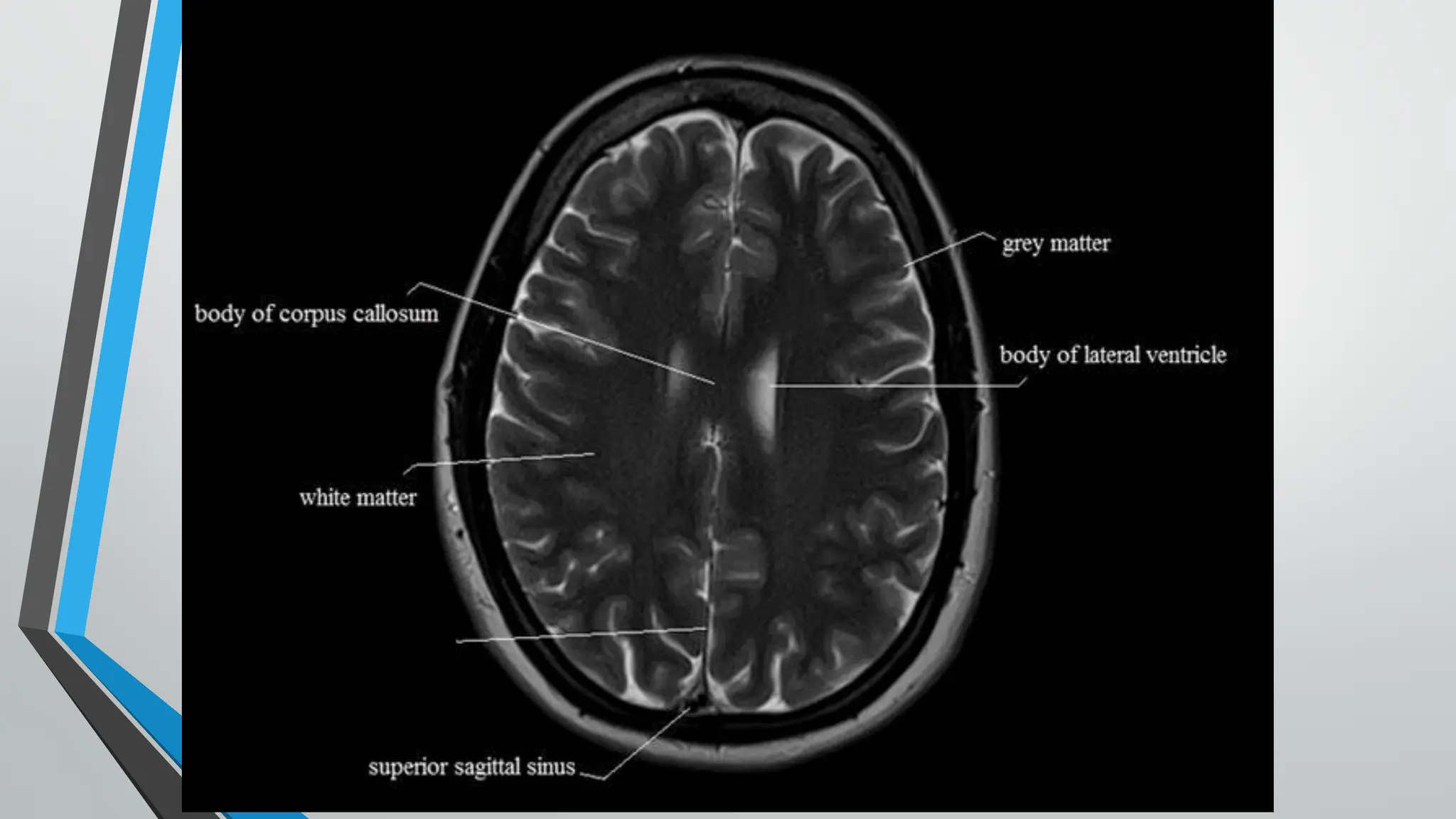 2- MRI Anatomy RMI 317 Brain Anatomy - Part 1 .pdf