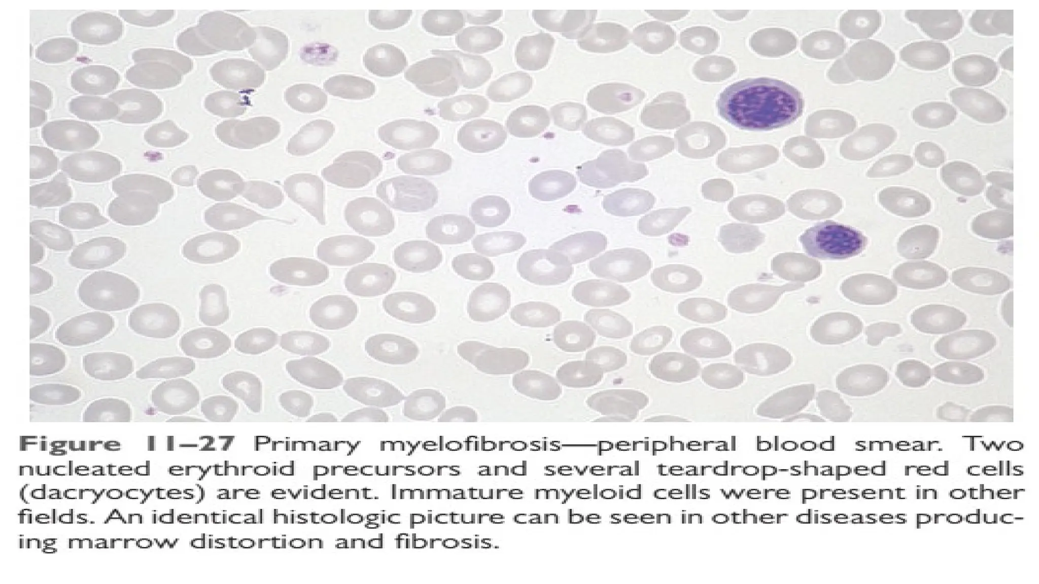 2- Myeloid Neoplasms hematopathology(2).pptx