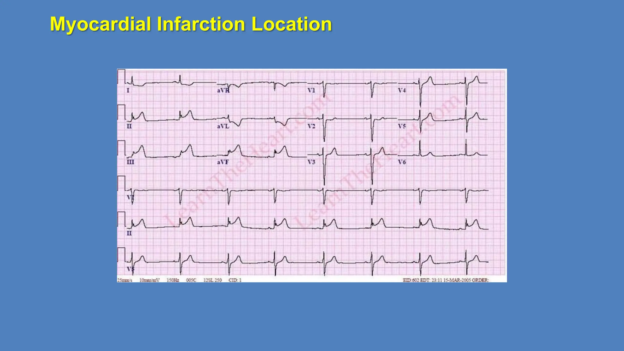 2- nursing care for Myocardial Infarction.pptx
