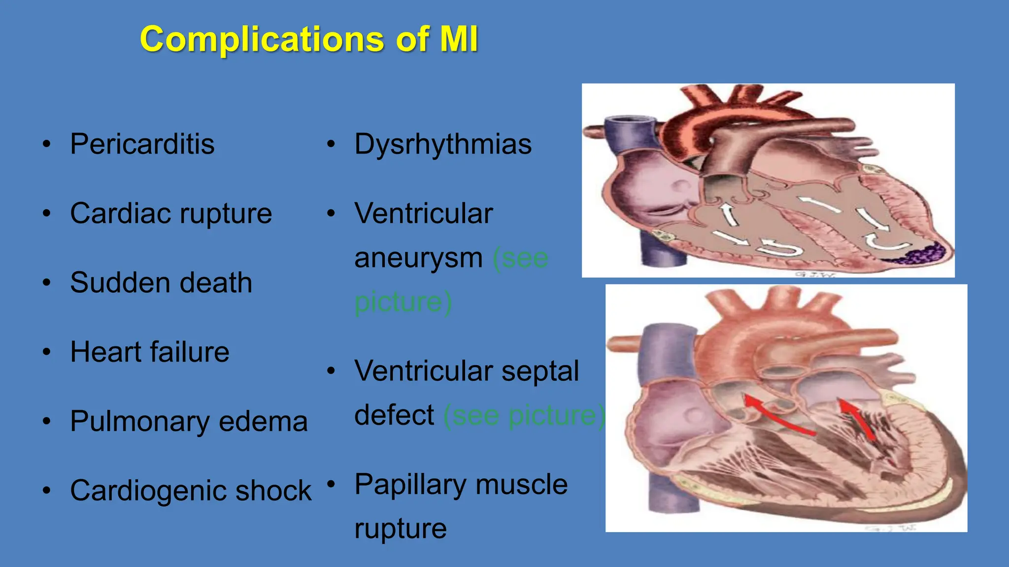 2- nursing care for Myocardial Infarction.pptx
