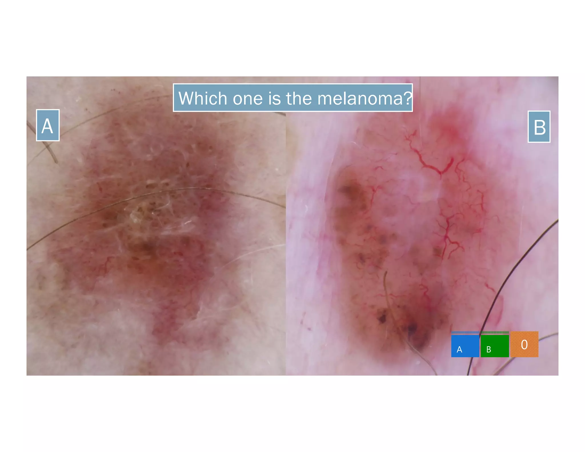 Melanoma Screening, Diagnosis, and Prevention – Kelly C. Nelson, MD | PDF