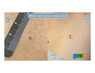 Melanoma Screening, Diagnosis, and Prevention – Kelly C. Nelson, MD | PDF