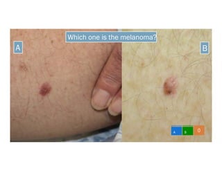 Melanoma Screening, Diagnosis, and Prevention – Kelly C. Nelson, MD | PDF