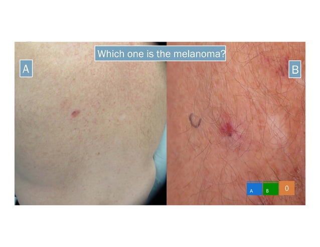 Melanoma Screening, Diagnosis, and Prevention – Kelly C. Nelson, MD | PPT