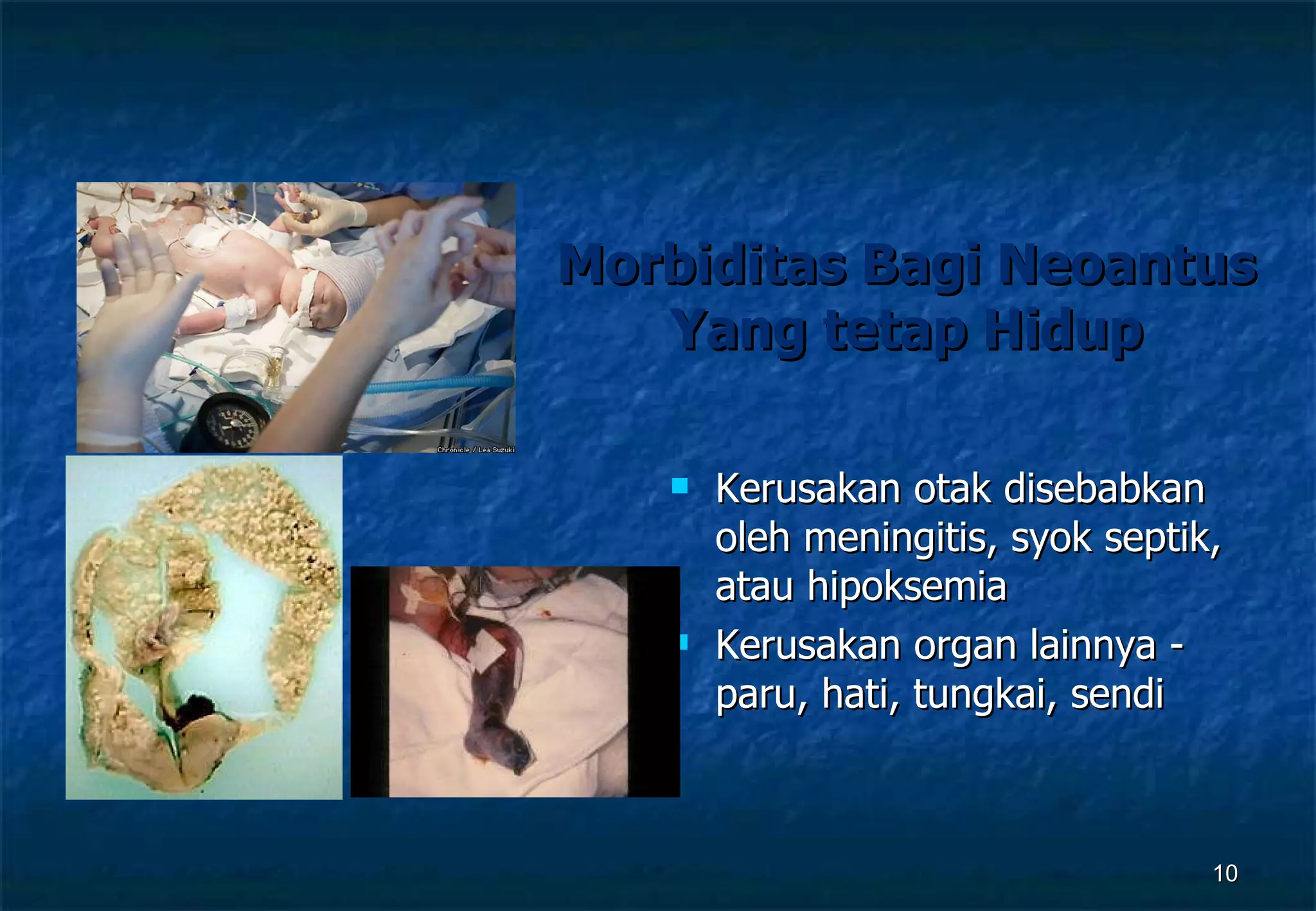 2..neonatal sepsis ponek | PPT