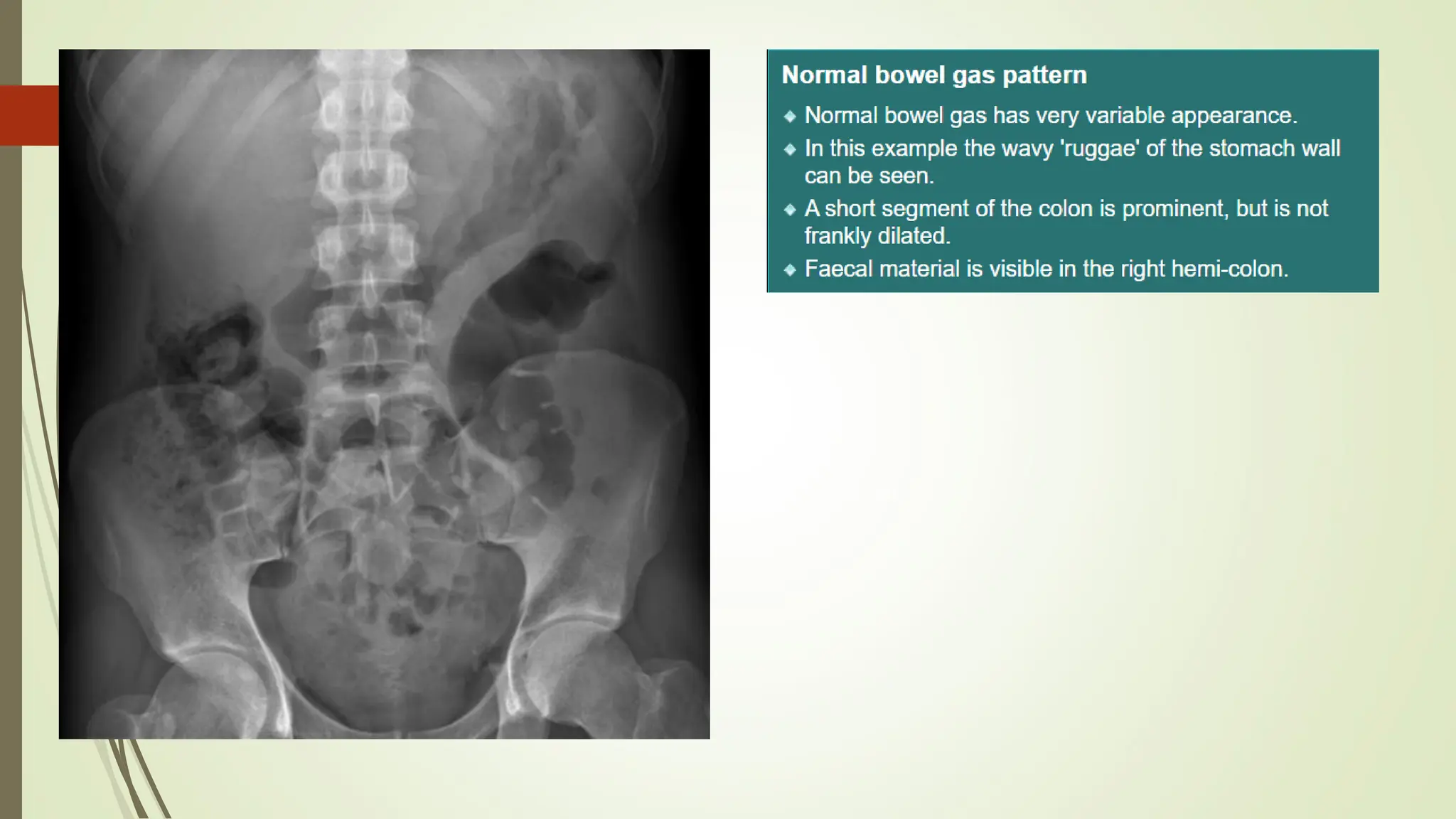 ABDOMINAL XRAYS REVIEW- NORMAL- INTRALUMINAL GASES | PDF