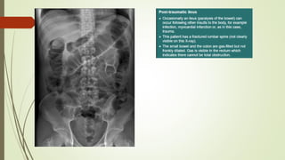 ABDOMINAL XRAYS REVIEW- NORMAL- INTRALUMINAL GASES | PDF