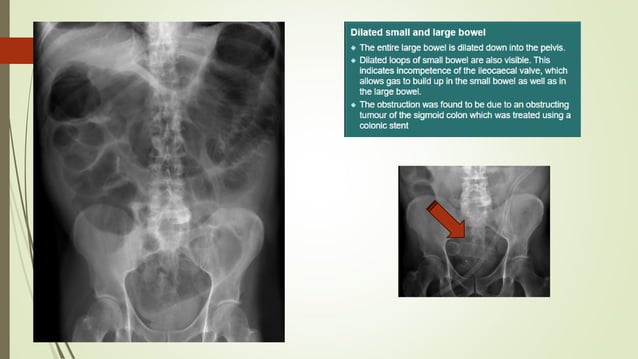 ABDOMINAL XRAYS REVIEW- NORMAL- INTRALUMINAL GASES | PDF