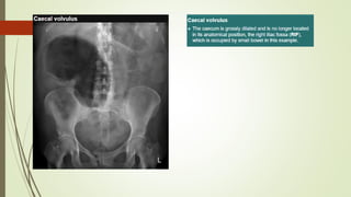 ABDOMINAL XRAYS REVIEW- NORMAL- INTRALUMINAL GASES | PPT