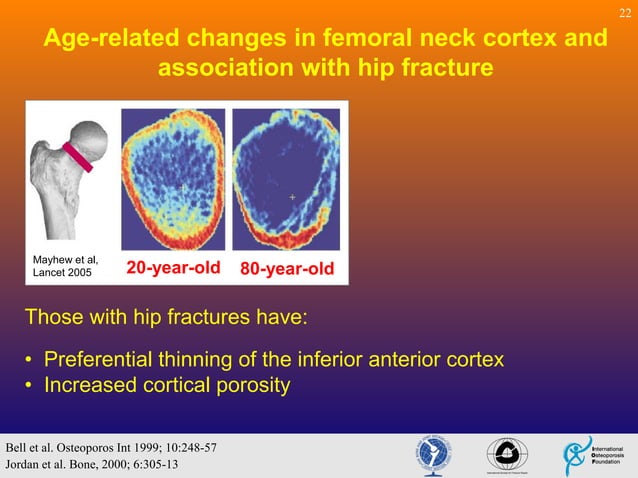 Fragility Fractures - Pathogenesis-Biomechanical View | PPT