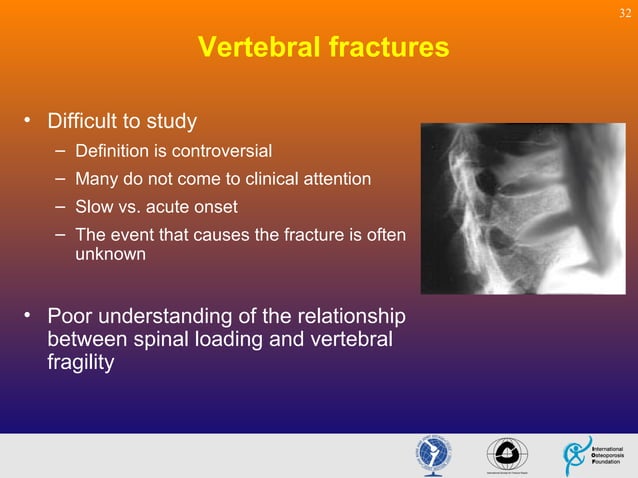 Fragility Fractures - Pathogenesis-Biomechanical View | PPT