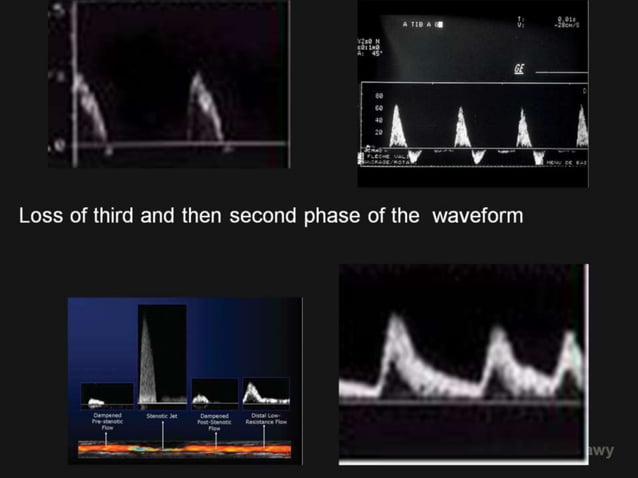 2 peripheral arterial triplex ultrasound waveform change dr ahmed esawy ...