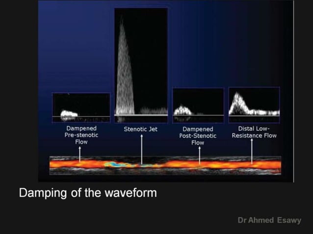 2 peripheral arterial triplex ultrasound waveform change dr ahmed esawy