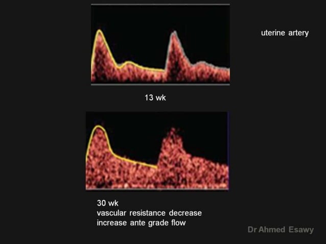 2 peripheral arterial triplex ultrasound waveform change dr ahmed esawy