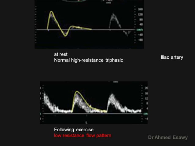 2 peripheral arterial triplex ultrasound waveform change dr ahmed esawy