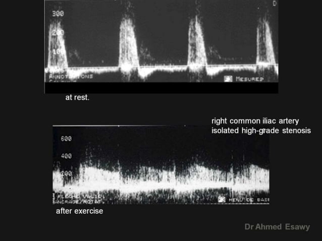 2 peripheral arterial triplex ultrasound waveform change dr ahmed esawy