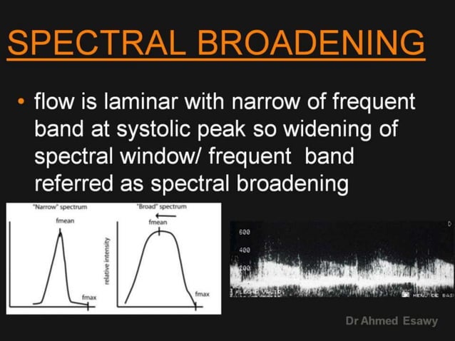 2 peripheral arterial triplex ultrasound waveform change dr ahmed esawy