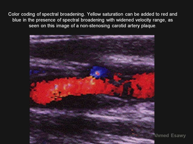 2 peripheral arterial triplex ultrasound waveform change dr ahmed esawy