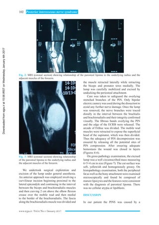 2 pin syndrome | PDF