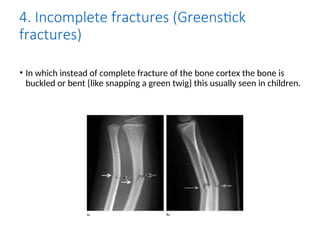 2- Principles_of_fractures for physiotherapy .ppt