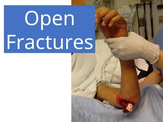 2- Principles_of_fractures for physiotherapy .ppt