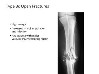 2- Principles_of_fractures for physiotherapy .ppt