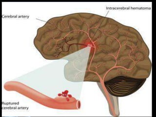 2 raised-intracranial-pressure | PPT
