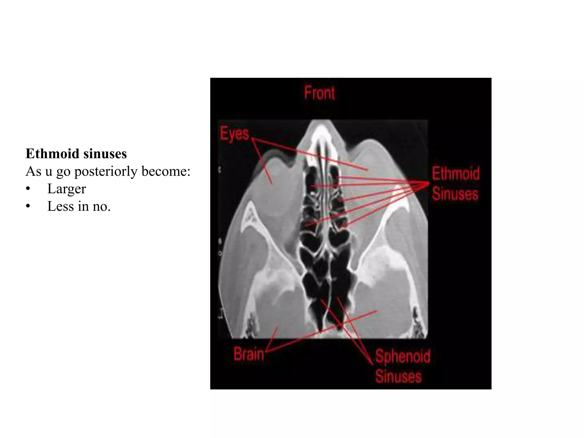 rhinosinusitis | PPTX