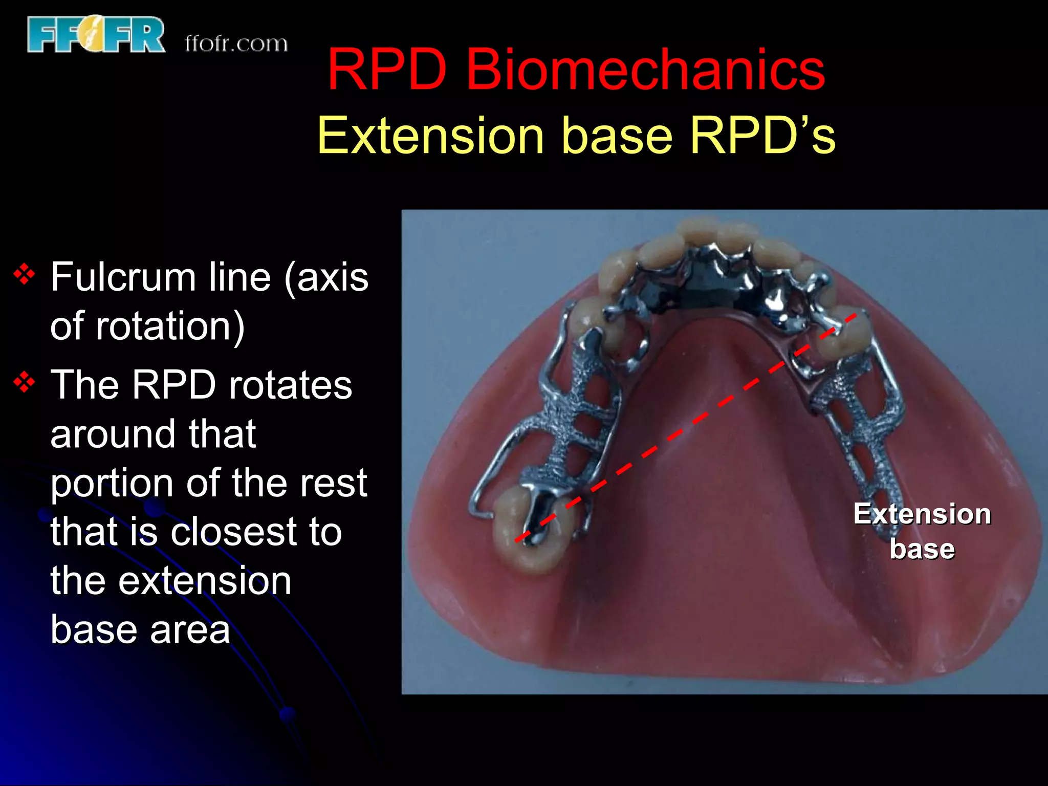 2.rpd biomechanics | PPT