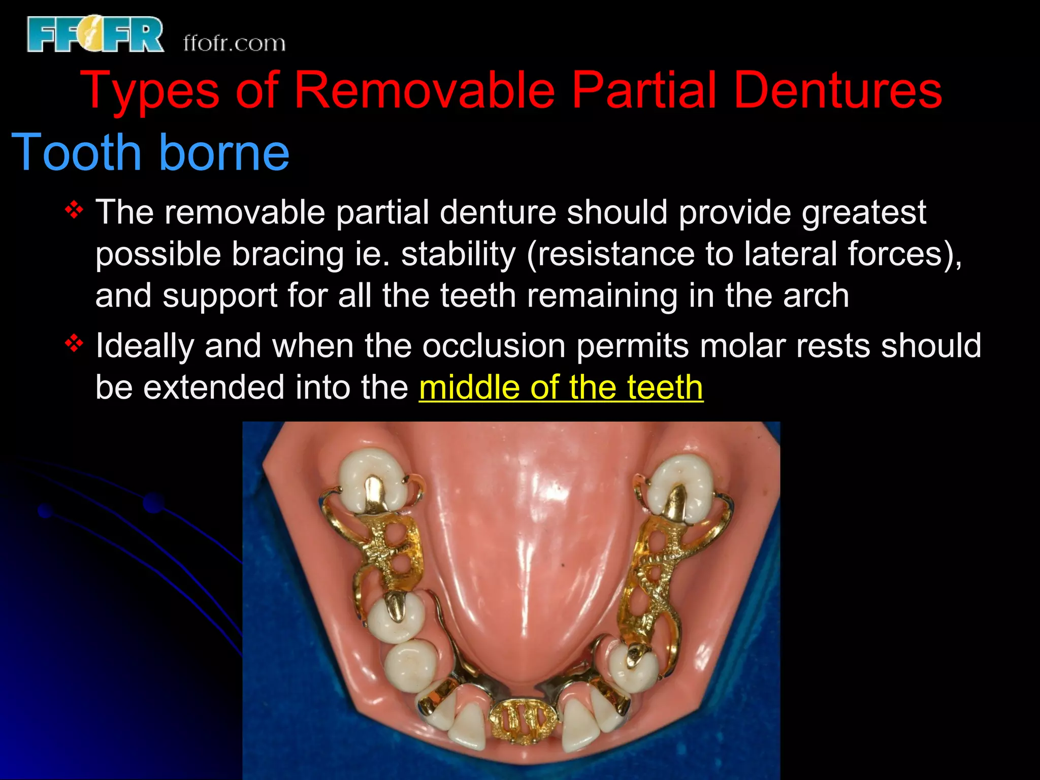 2.rpd biomechanics | PPT