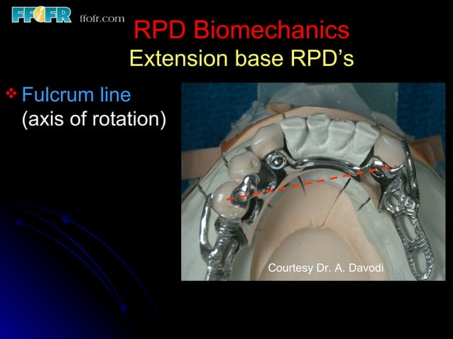 2.rpd biomechanics | PPT | Dental Health | Diseases and Conditions
