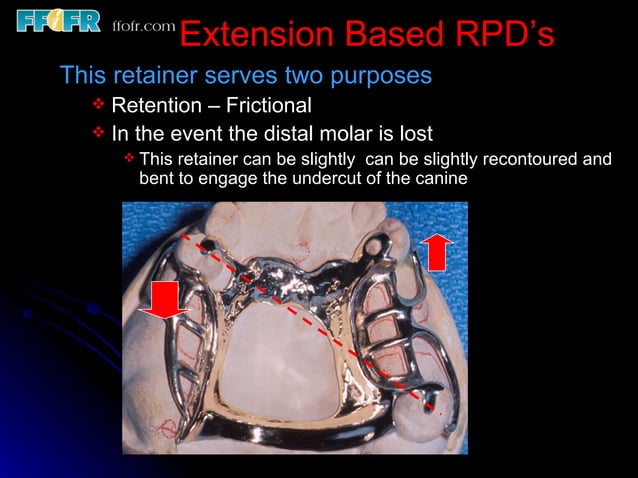 2.rpd biomechanics | PPT | Dental Health | Diseases and Conditions
