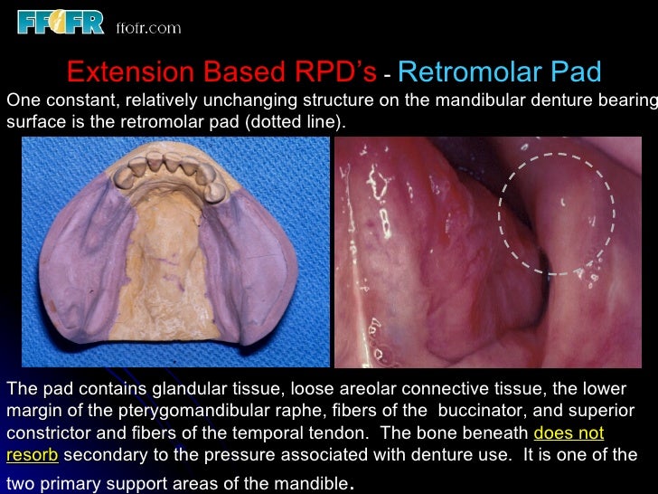 Retromolar Area