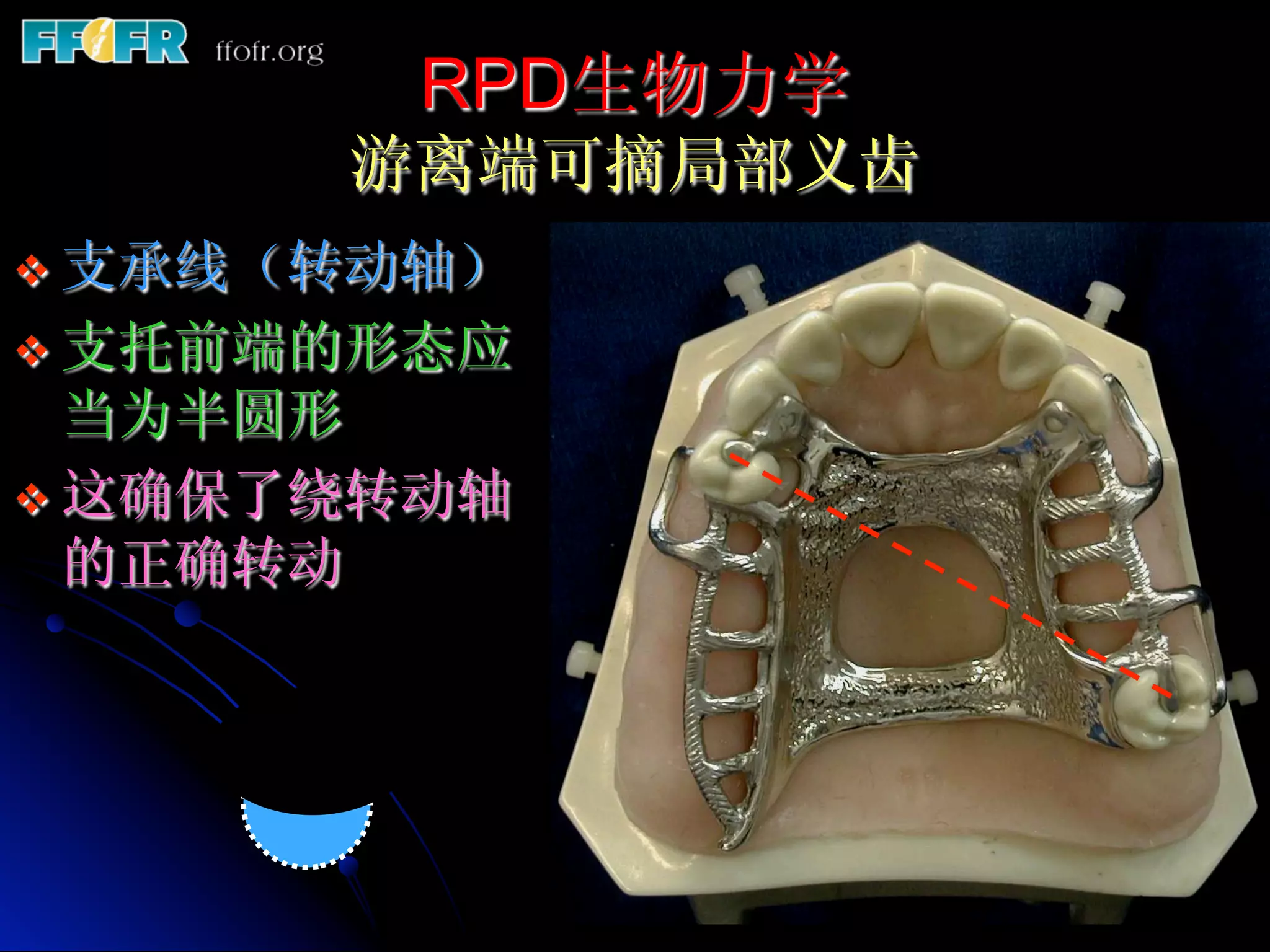 2.rpd biomechanics | PDF