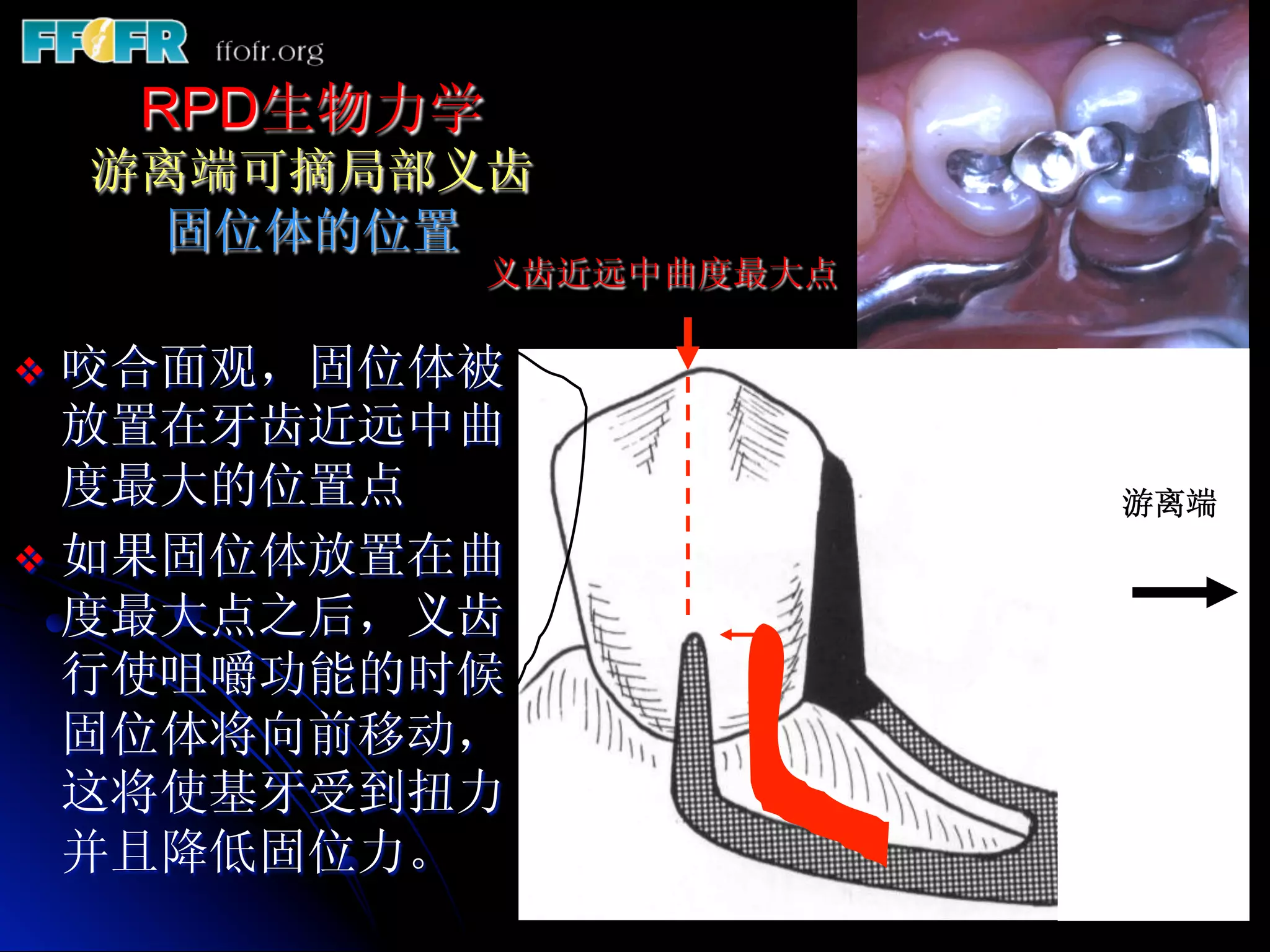 2.rpd biomechanics | PDF
