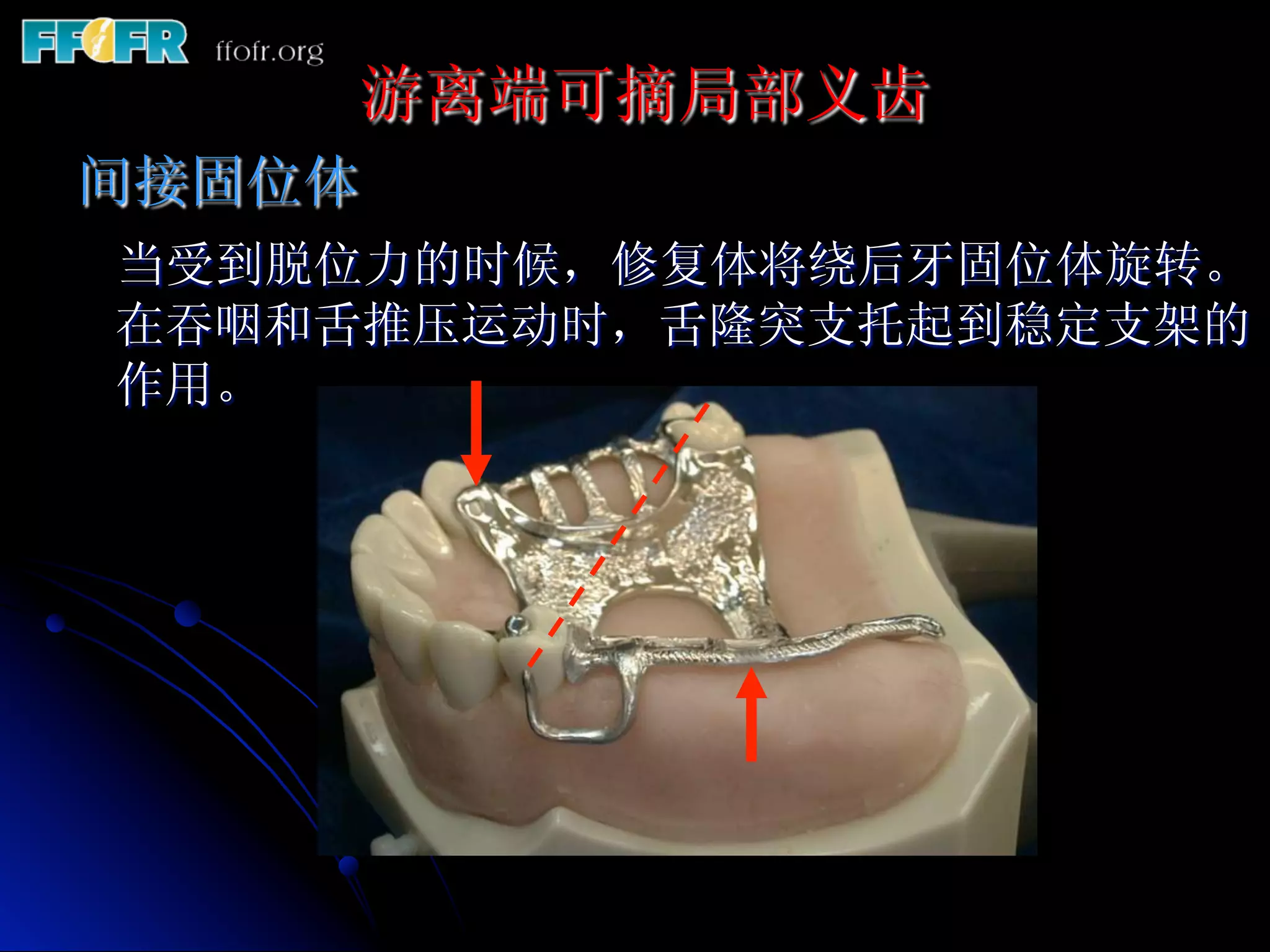2.rpd biomechanics | PDF
