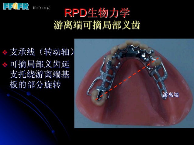 2.rpd biomechanics | PDF