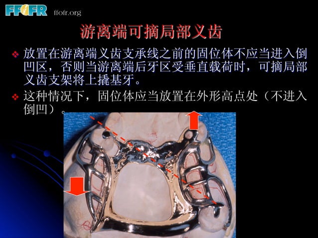 2.rpd biomechanics | PDF
