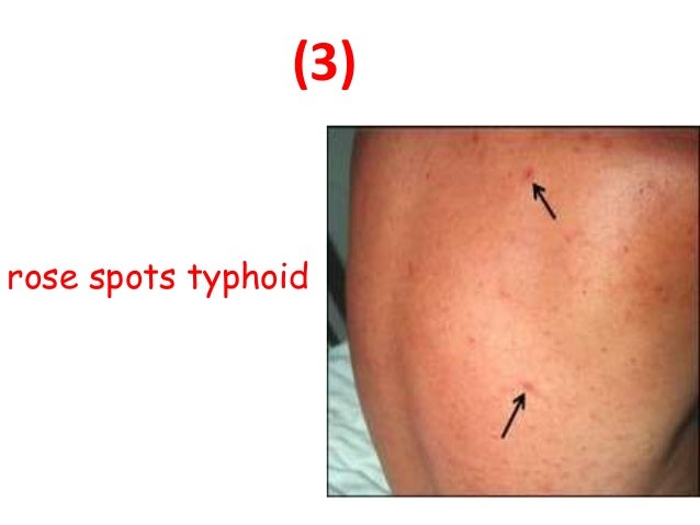 Salmonella Typhi Rose Spots