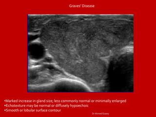 thyriod gland imaging part 2 (full story diffuse thyriod disease) Dr ...