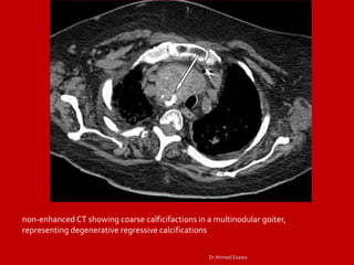 thyriod gland imaging part 2 (full story diffuse thyriod disease) Dr ...